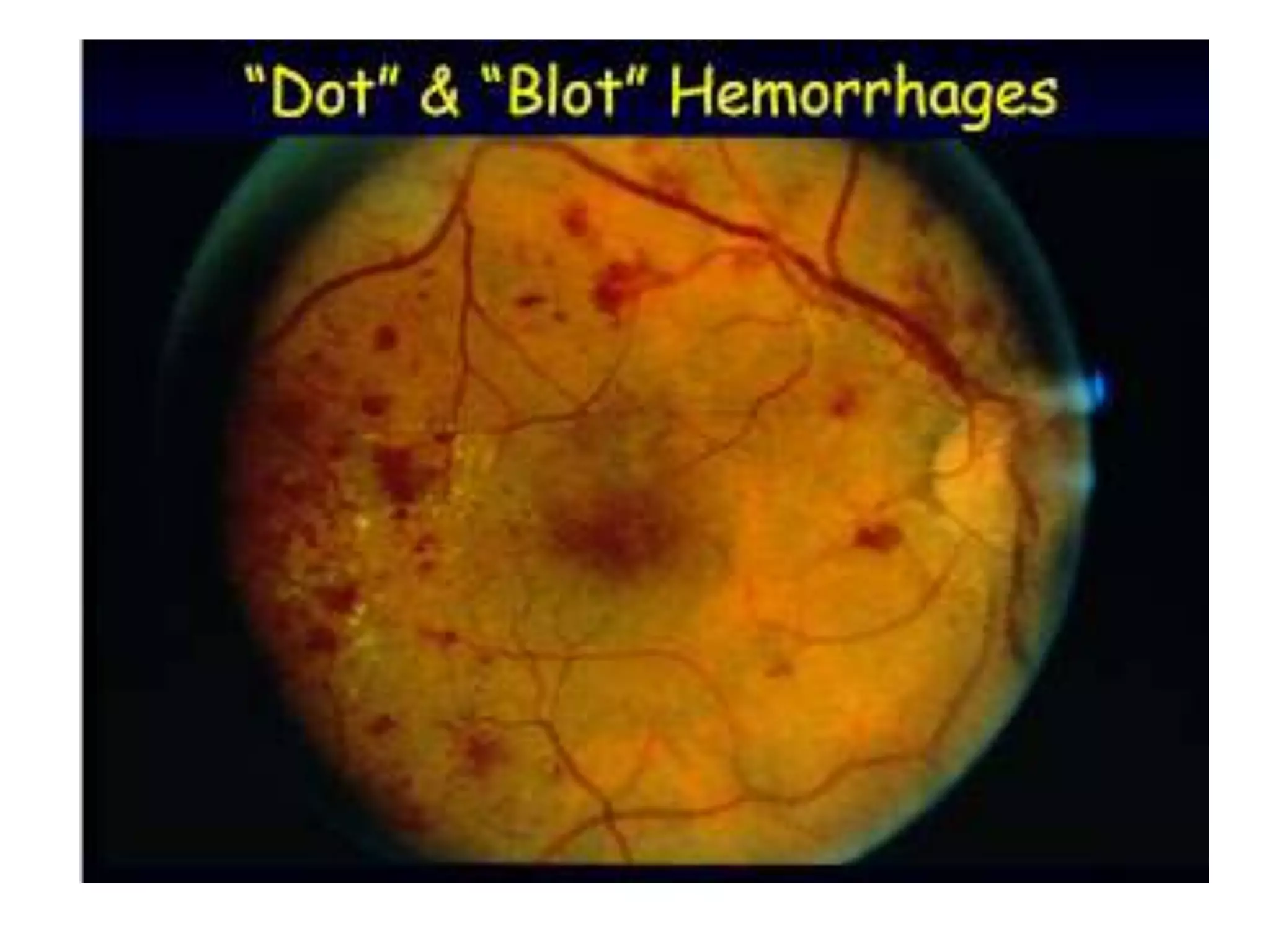 Diabetic Retinopathy (Molecular mechanisms,types,fundoscopy,diagnosis ...