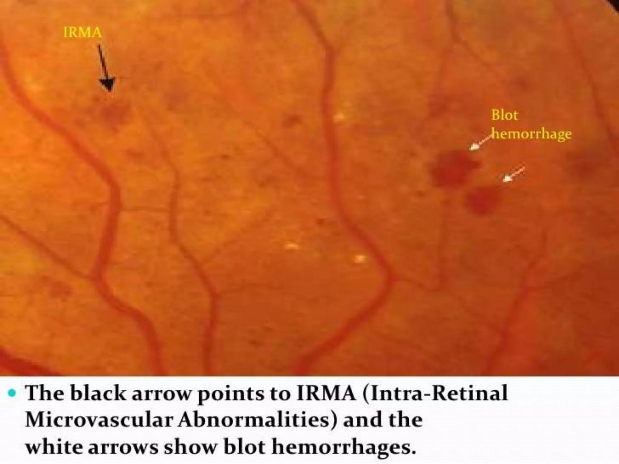 Diabetic Retinopathy (Molecular mechanisms,types,fundoscopy,diagnosis ...