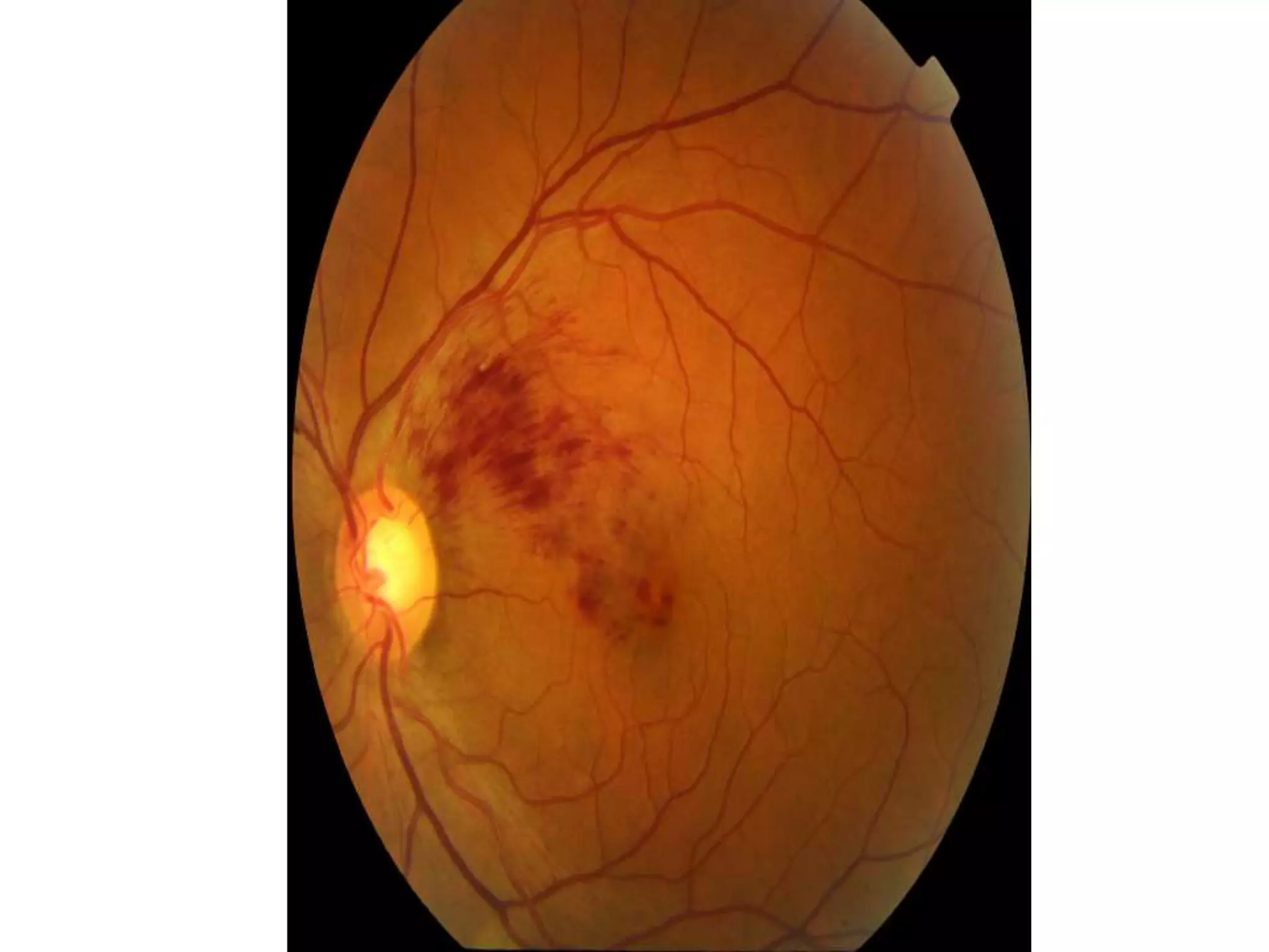 Diabetic Retinopathy (Molecular mechanisms,types,fundoscopy,diagnosis ...