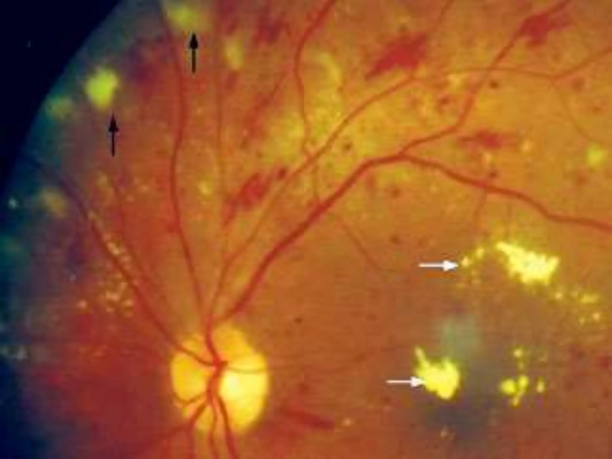 Diabetic Retinopathy (Molecular mechanisms,types,fundoscopy,diagnosis ...