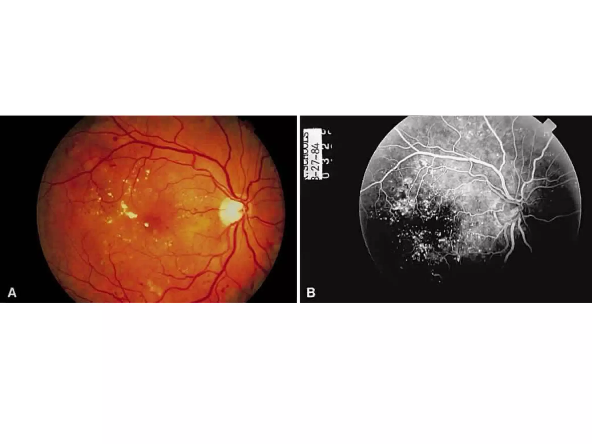Diabetic Retinopathy (Molecular mechanisms,types,fundoscopy,diagnosis ...