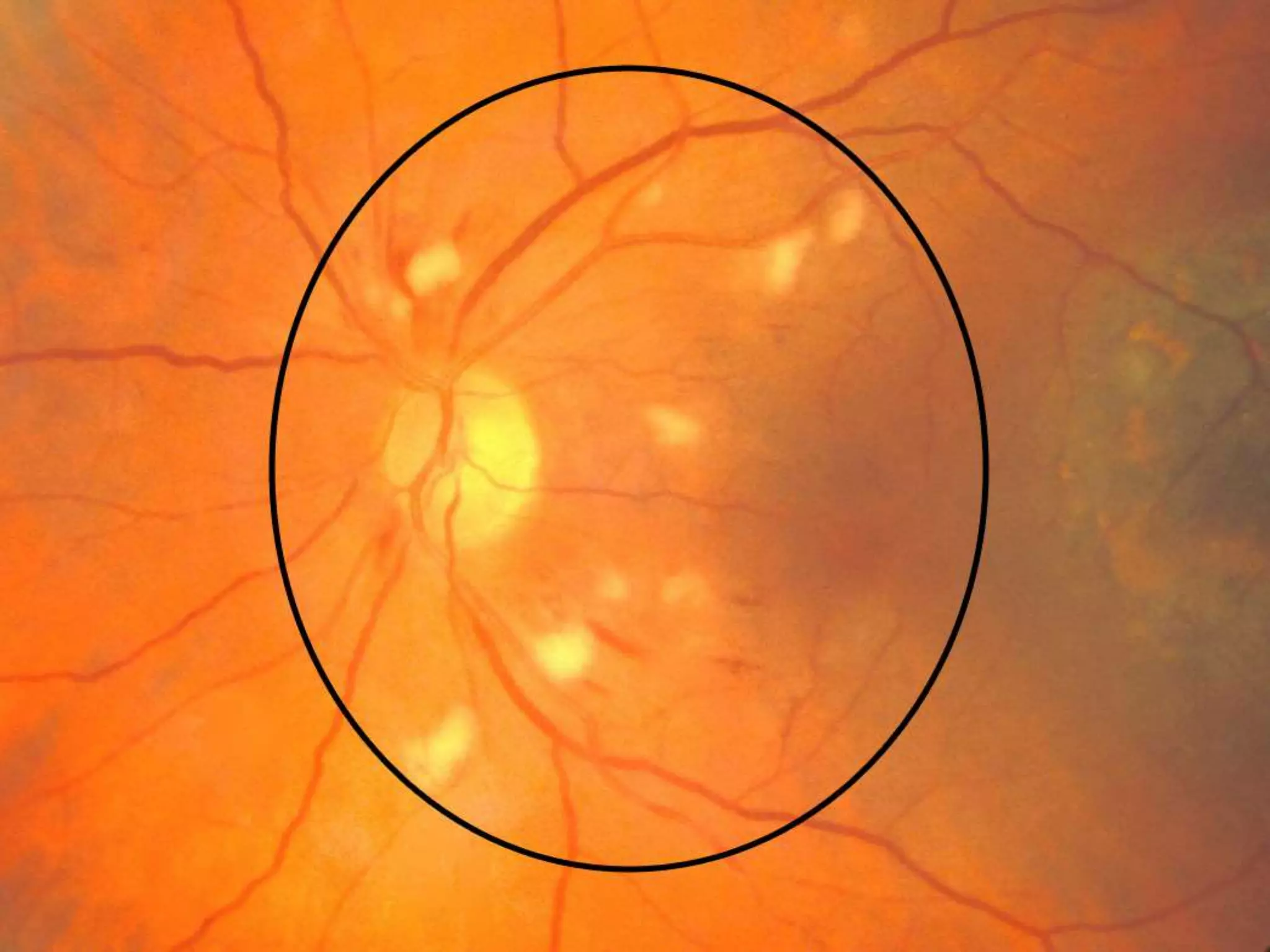 Diabetic Retinopathy (Molecular mechanisms,types,fundoscopy,diagnosis ...