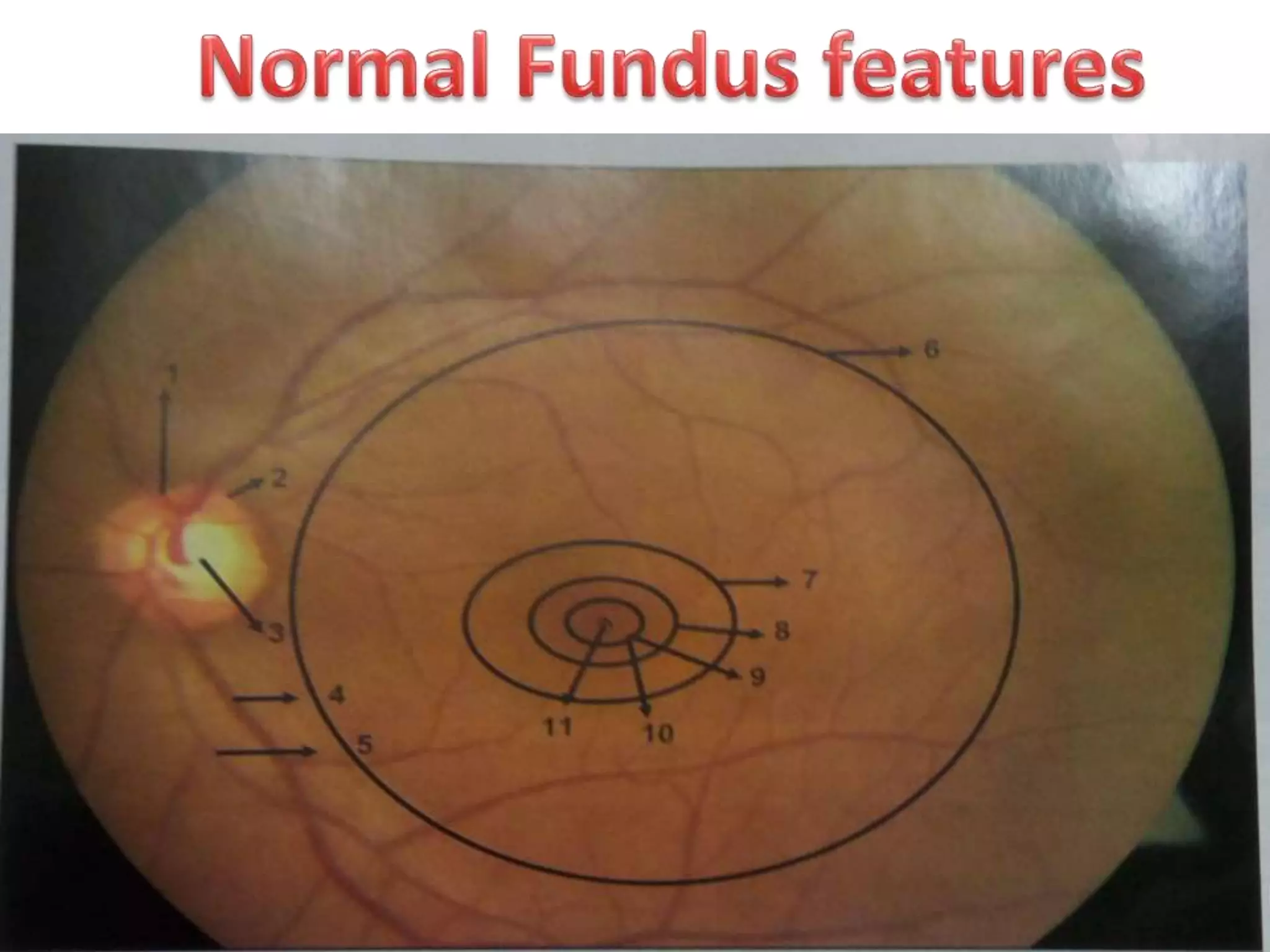 Diabetic Retinopathy (Molecular mechanisms,types,fundoscopy,diagnosis ...