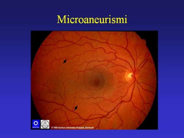 Diabetic Retinopathy (Molecular mechanisms,types,fundoscopy,diagnosis ...
