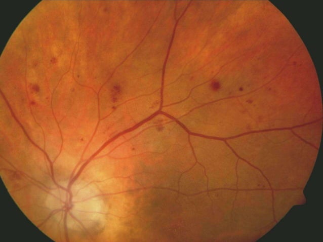 Diabetic Retinopathy (Molecular mechanisms,types,fundoscopy,diagnosis ...
