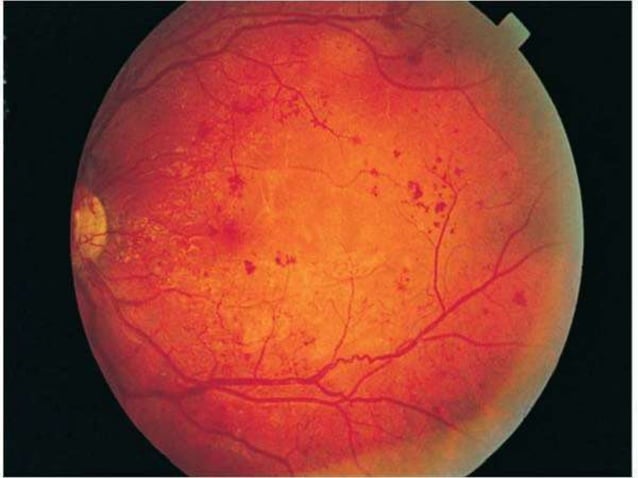 Diabetic Retinopathy (Molecular mechanisms,types,fundoscopy,diagnosis ...