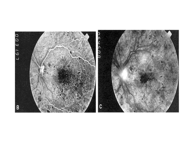 Diabetic Retinopathy (Molecular mechanisms,types,fundoscopy,diagnosis ...