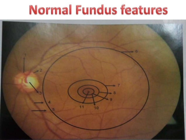 Diabetic Retinopathy (Molecular mechanisms,types,fundoscopy,diagnosis ...