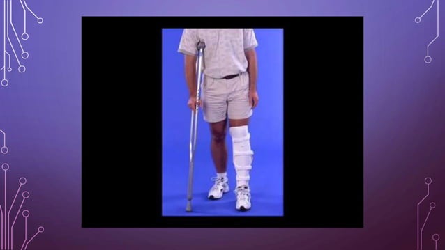 functional cast bracing -sarmiento ,ptb cast -s.senthil sailesh | PPTX