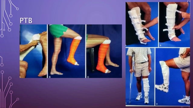 Dr.S.Senthil Sailesh-functional cast bracing,PTBcast,sarmiento principle