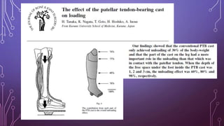 Patellar Tendon Bearing Cast