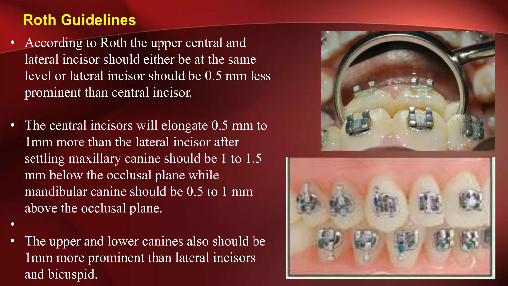 Bracket positioning | PPTX
