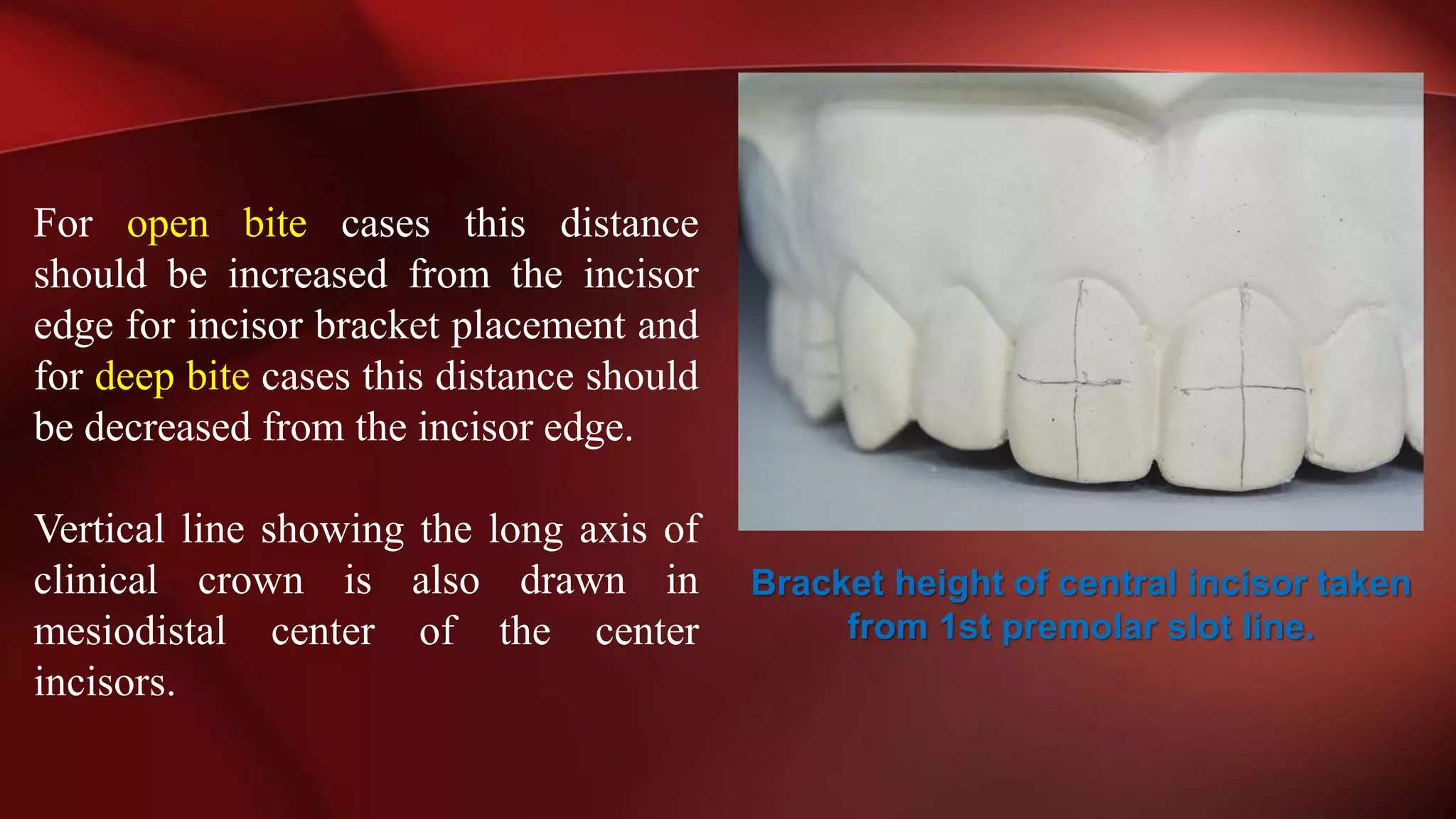 Bracket positioning | PPTX