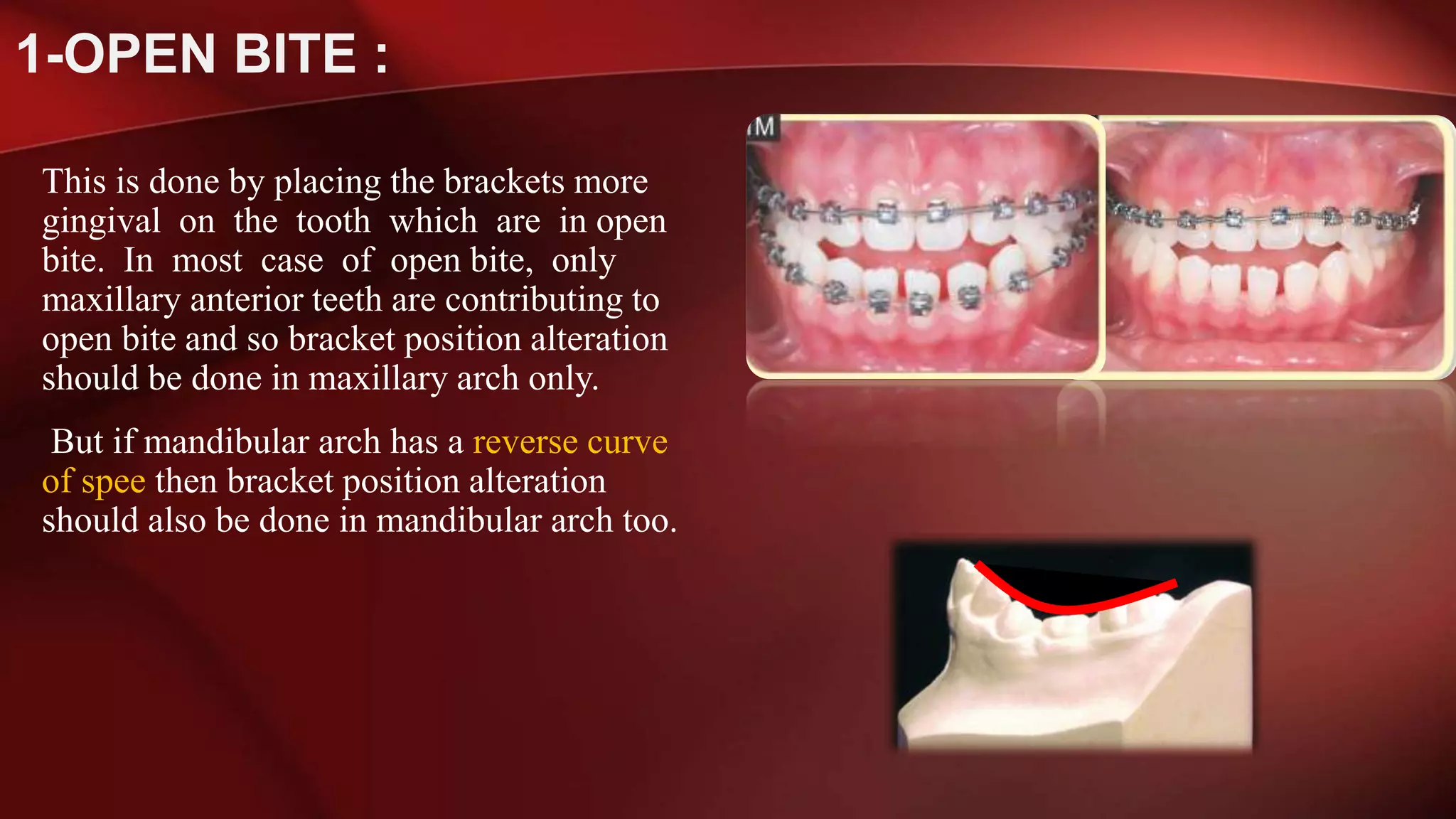 Bracket positioning | PPTX