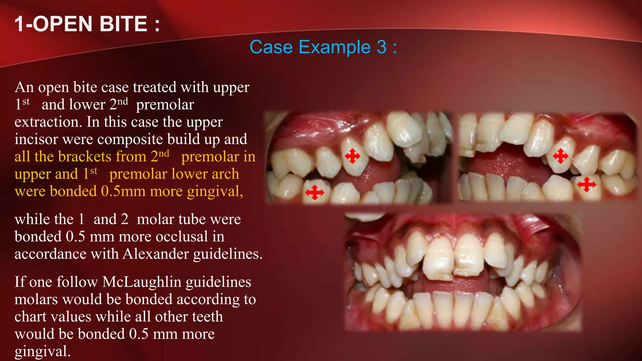 Bracket positioning | PPTX