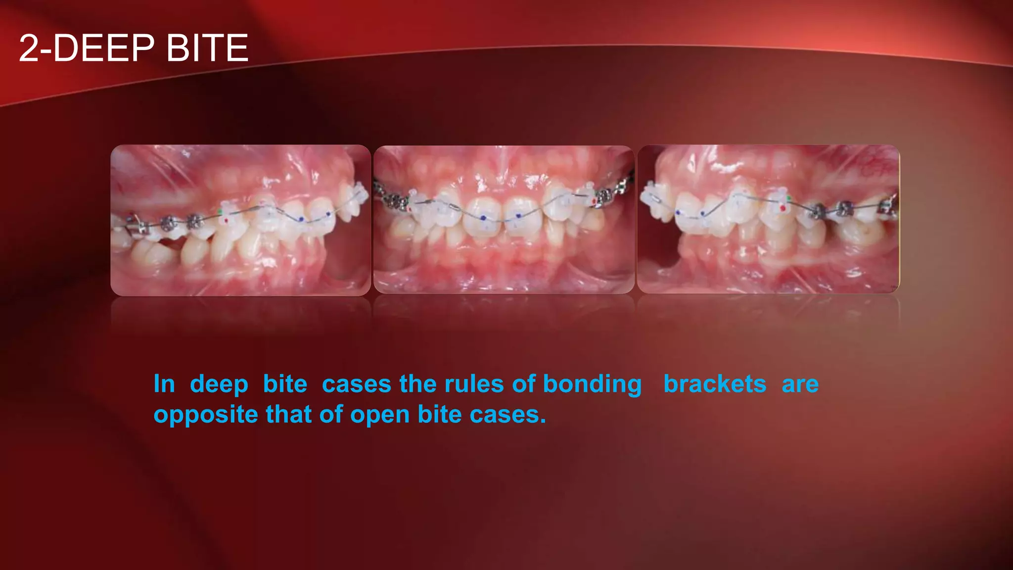 Bracket positioning | PPTX