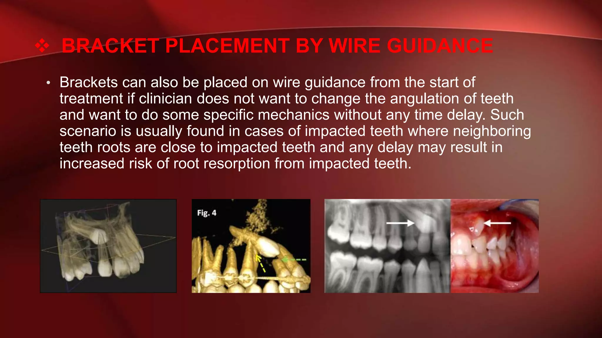 Bracket positioning | PPTX