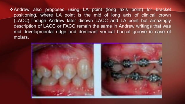Bracket positioning | PPTX | Dental Health | Diseases and Conditions