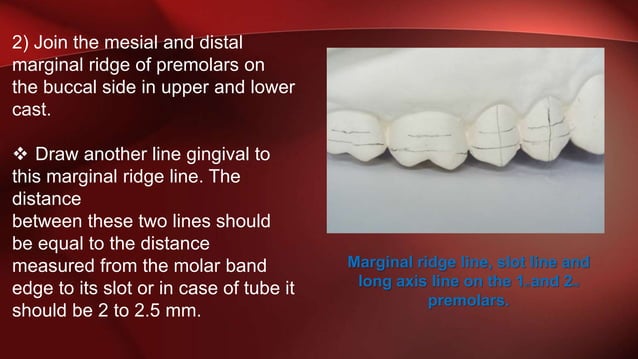 Bracket positioning | PPTX | Dental Health | Diseases and Conditions