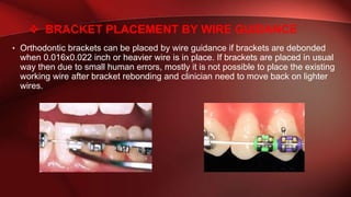 Bracket positioning | PPTX