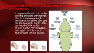 Bracket positioning | PPTX
