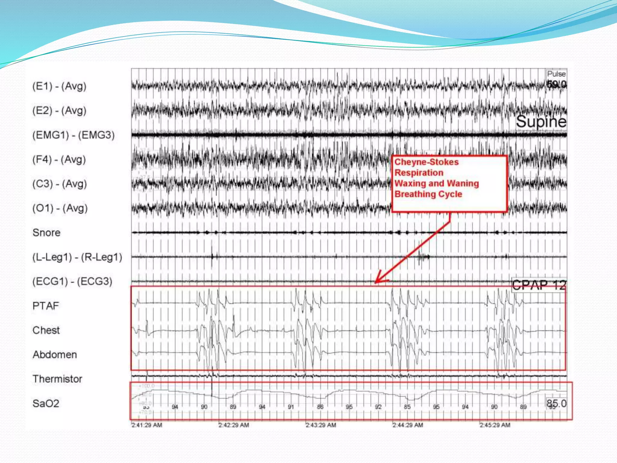 OSA & COPD (OVERLAP SYNDROME) | PPTX