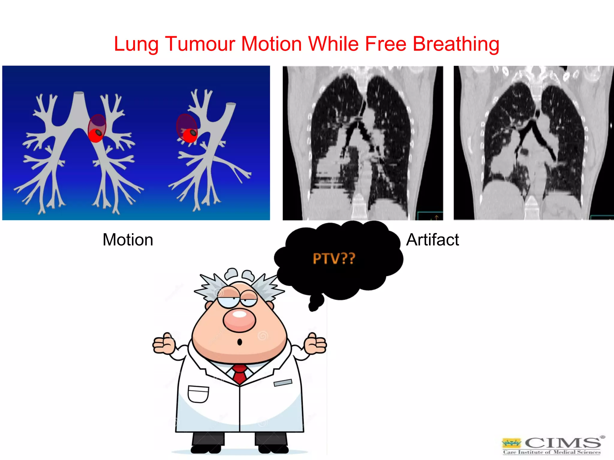 4D-CBCT (Symmetry) - a useful tool to verify and treat traditional ITV ...