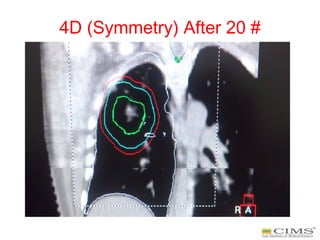 4D-CBCT (Symmetry) - a useful tool to verify and treat traditional ITV ...