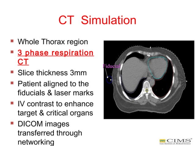 4D-CBCT (Symmetry) - a useful tool to verify and treat traditional ITV ...