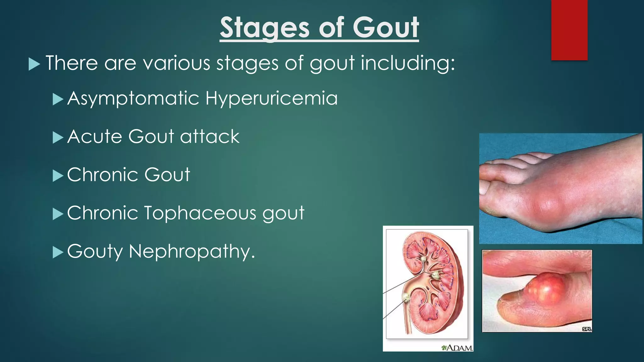 Gout and Hyperuricemia | PDF