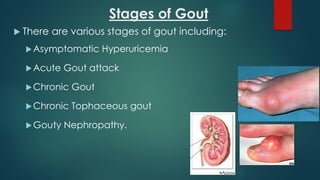 Gout and Hyperuricemia | PDF