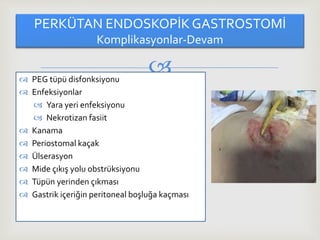 Perkutan Endoskopik Gastrostomi ve Hemsirelik Uygulamaları | PPTX