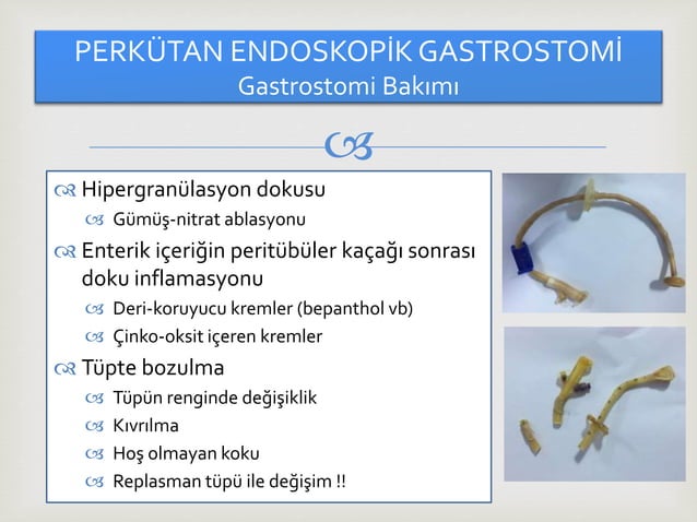 Perkutan Endoskopik Gastrostomi ve Hemsirelik Uygulamaları | PPTX