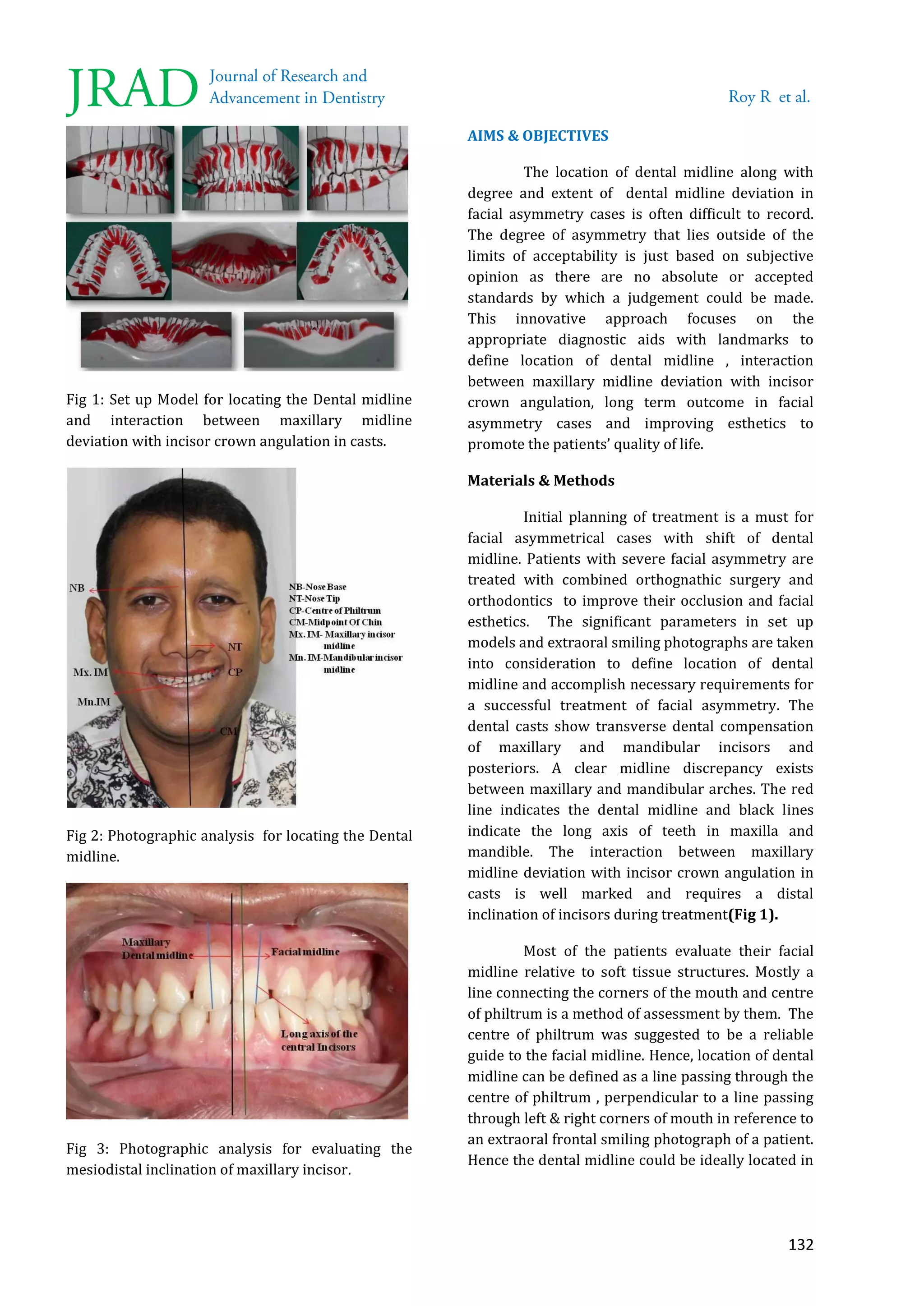 Determination Of Dental Midline in Camouflage Orthodontic Treatment Of ...