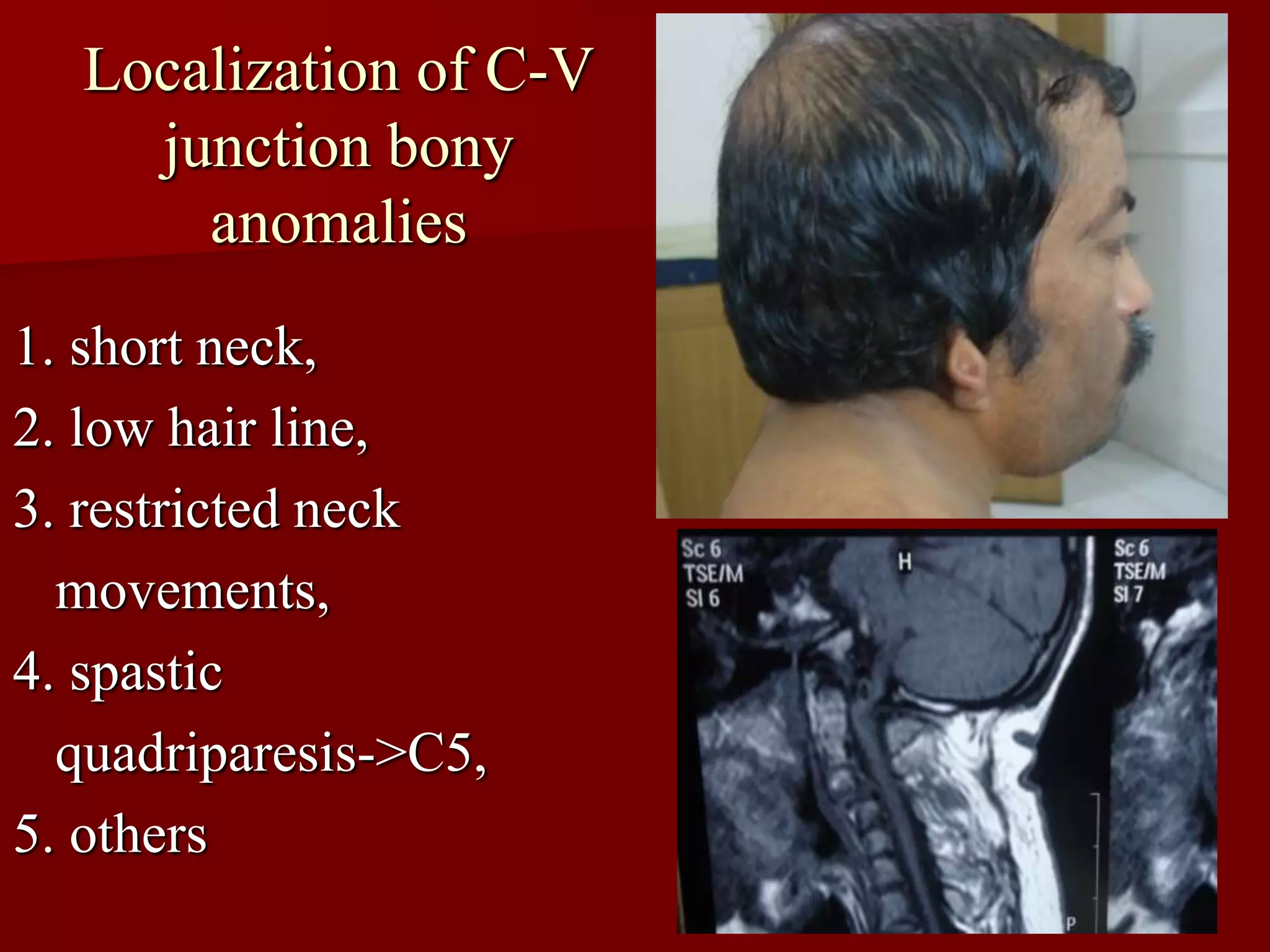 localization spinal cord | PPTX