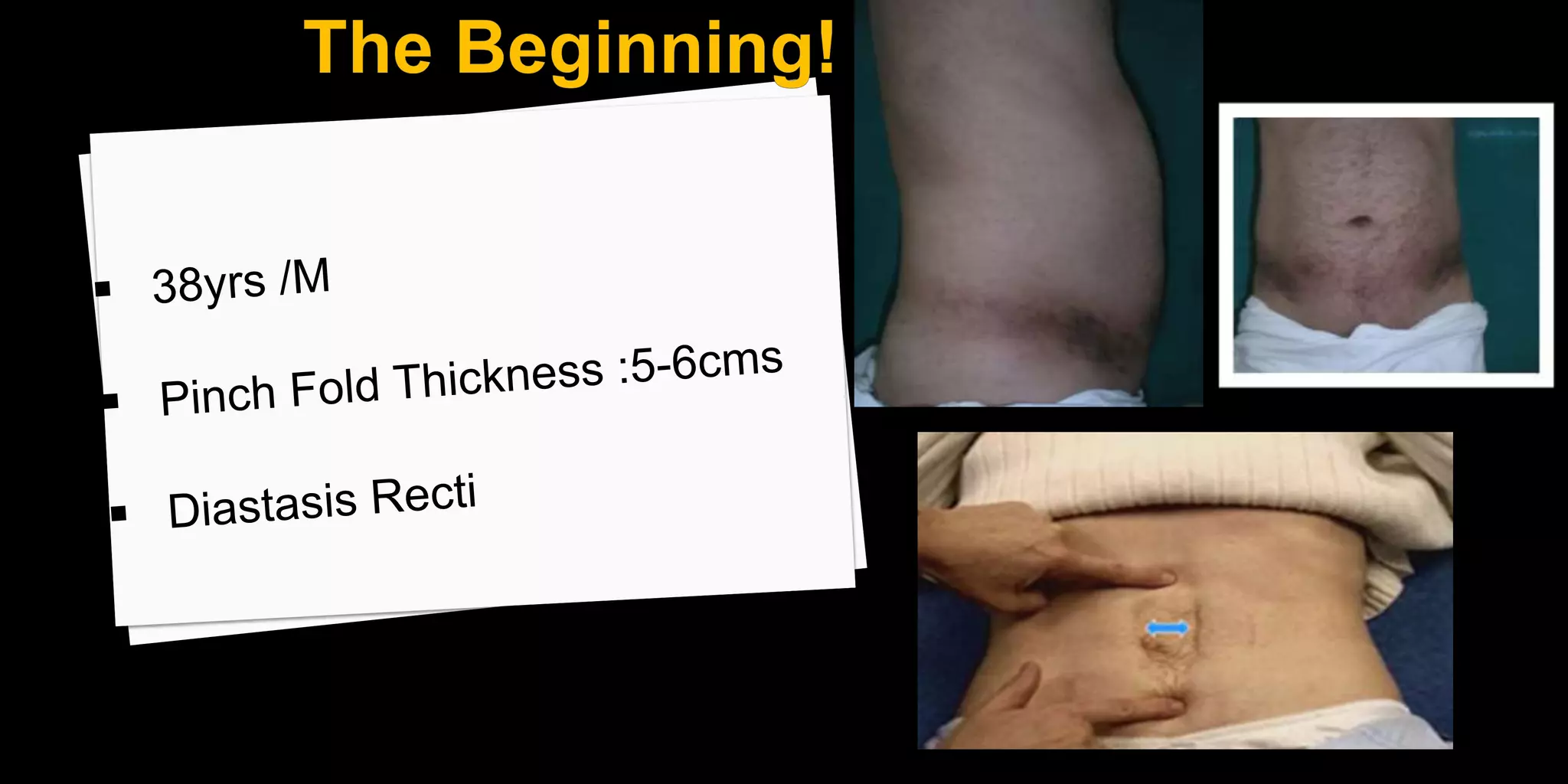 Endoscopically Assisted Repair of Diastasis Rectii by Dr Sumita Shankar ...