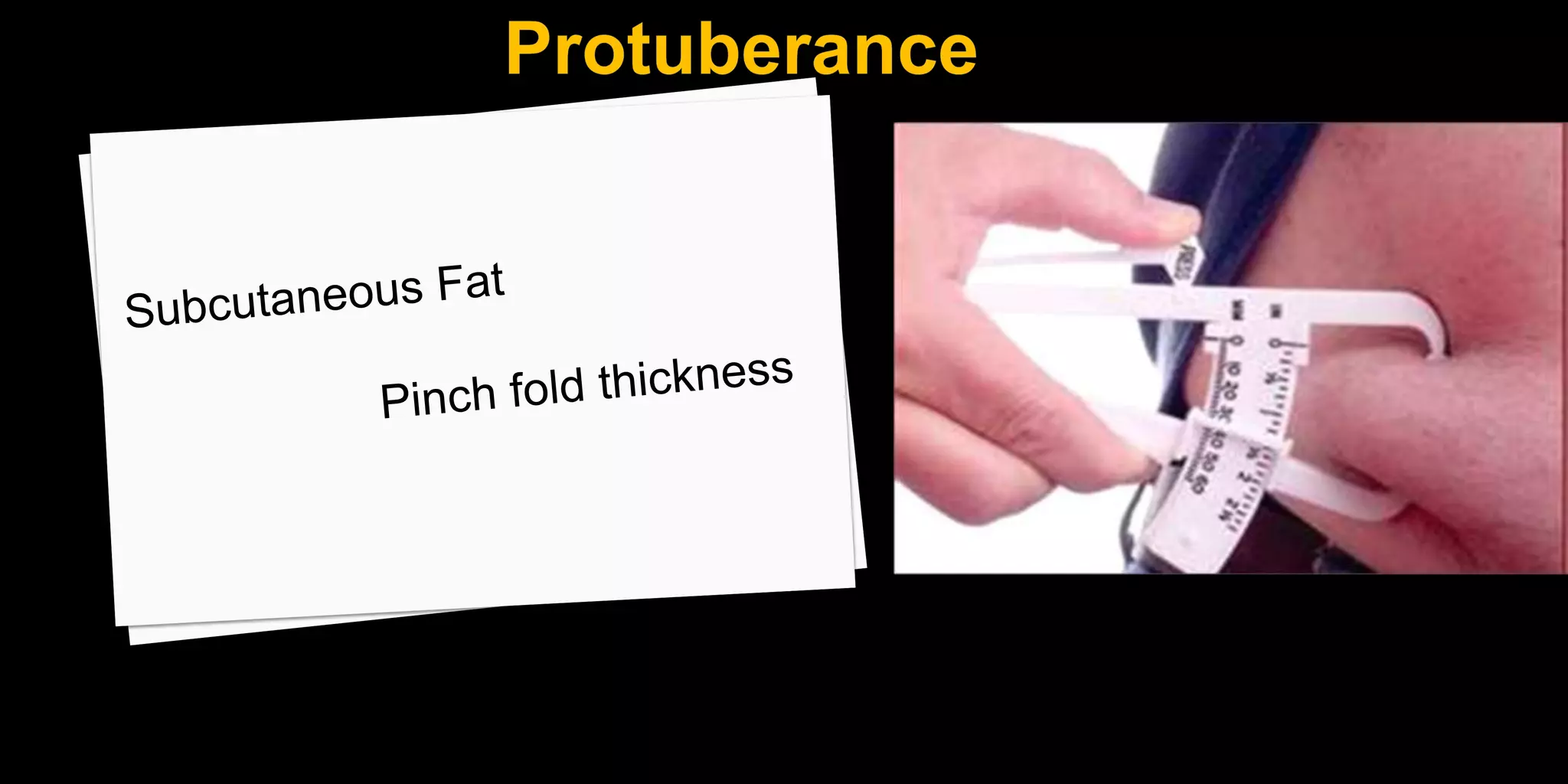 Endoscopically Assisted Repair of Diastasis Rectii by Dr Sumita Shankar ...