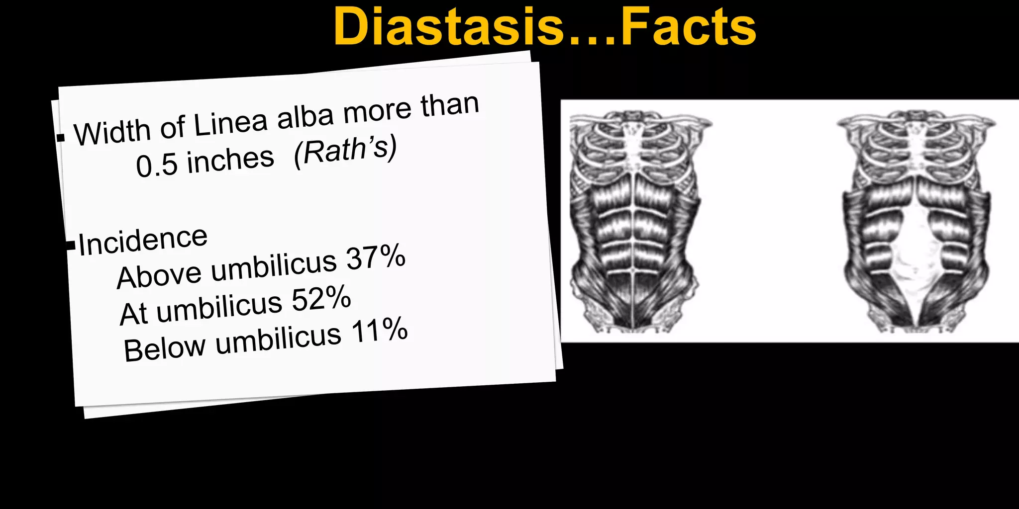 Endoscopically Assisted Repair of Diastasis Rectii by Dr Sumita Shankar ...
