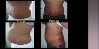Endoscopically Assisted Repair of Diastasis Rectii by Dr Sumita Shankar ...