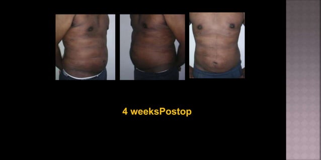 Endoscopically Assisted Repair of Diastasis Rectii by Dr Sumita Shankar ...