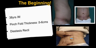 Endoscopically Assisted Repair of Diastasis Rectii by Dr Sumita Shankar ...