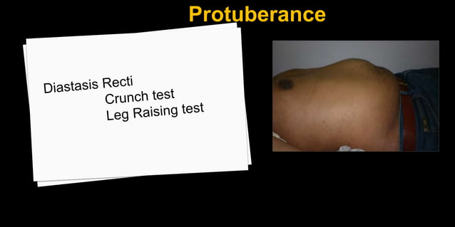 Endoscopically Assisted Repair of Diastasis Rectii by Dr Sumita Shankar ...
