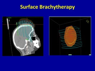 brachytherapy | PPTX
