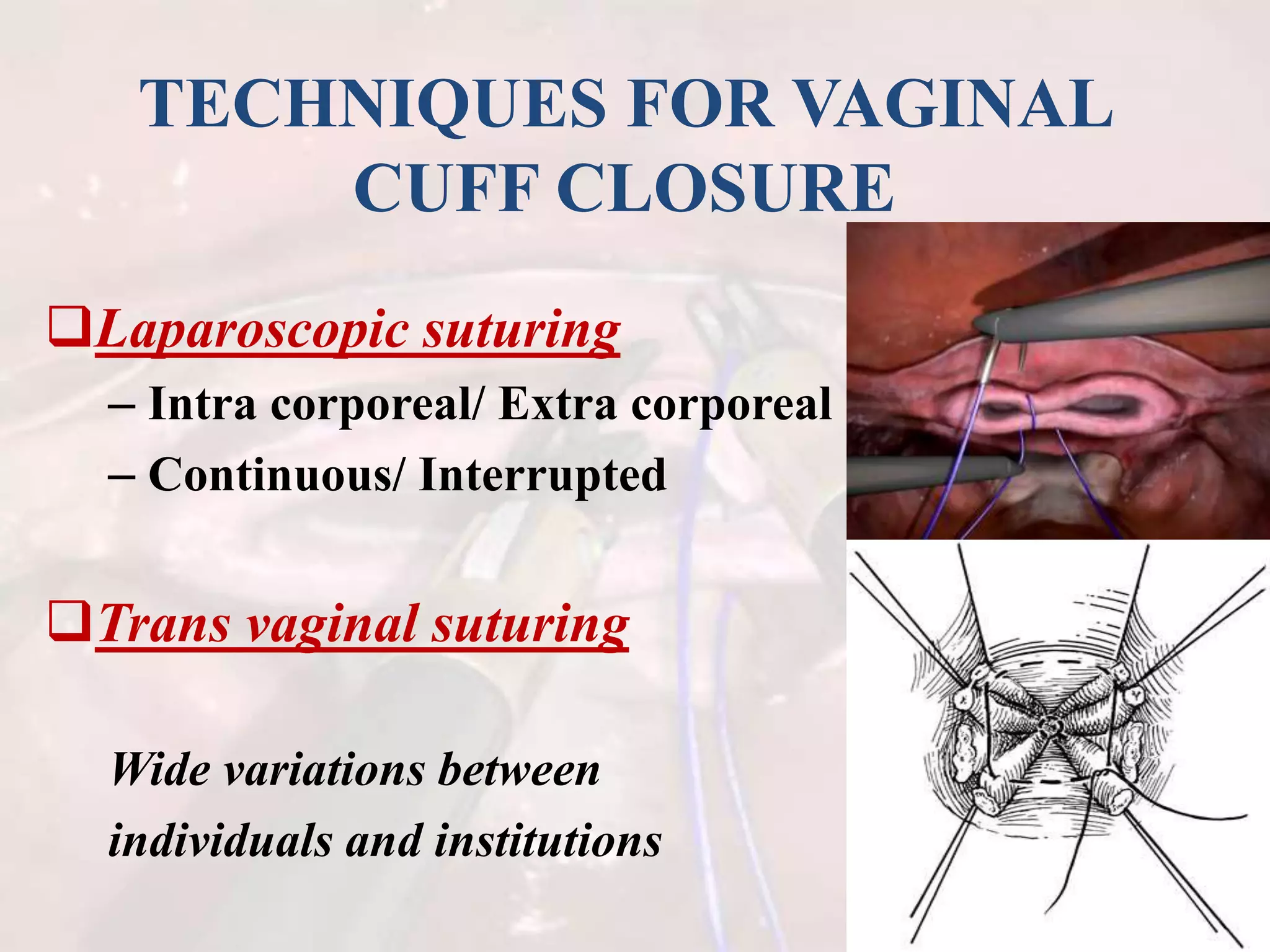 Vaginal Vault suturing in TLH | PPTX