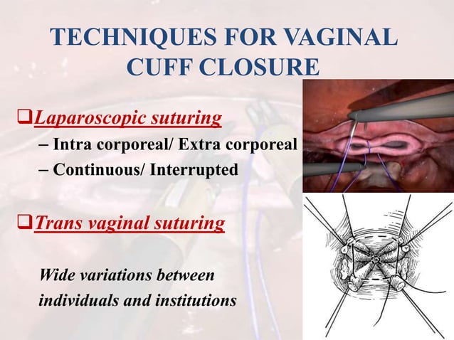 Vaginal Vault suturing in TLH | PPTX | Reproductive Health | Diseases ...