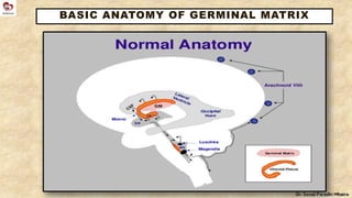 Neonatal Cranial Bleed with Intraventricular hemorrhage | PPTX
