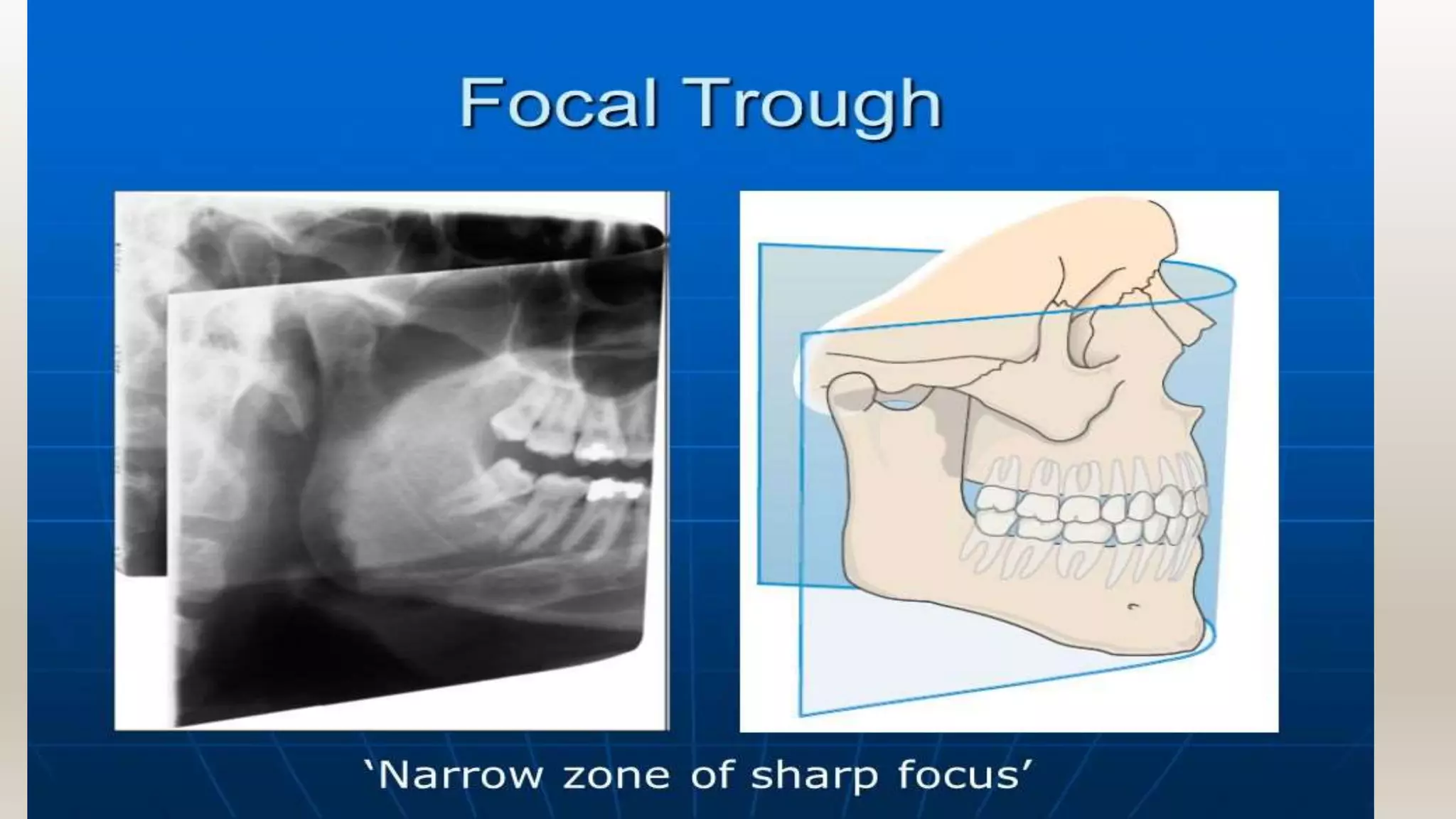 Radiographic Considerations in Implants | PPTX