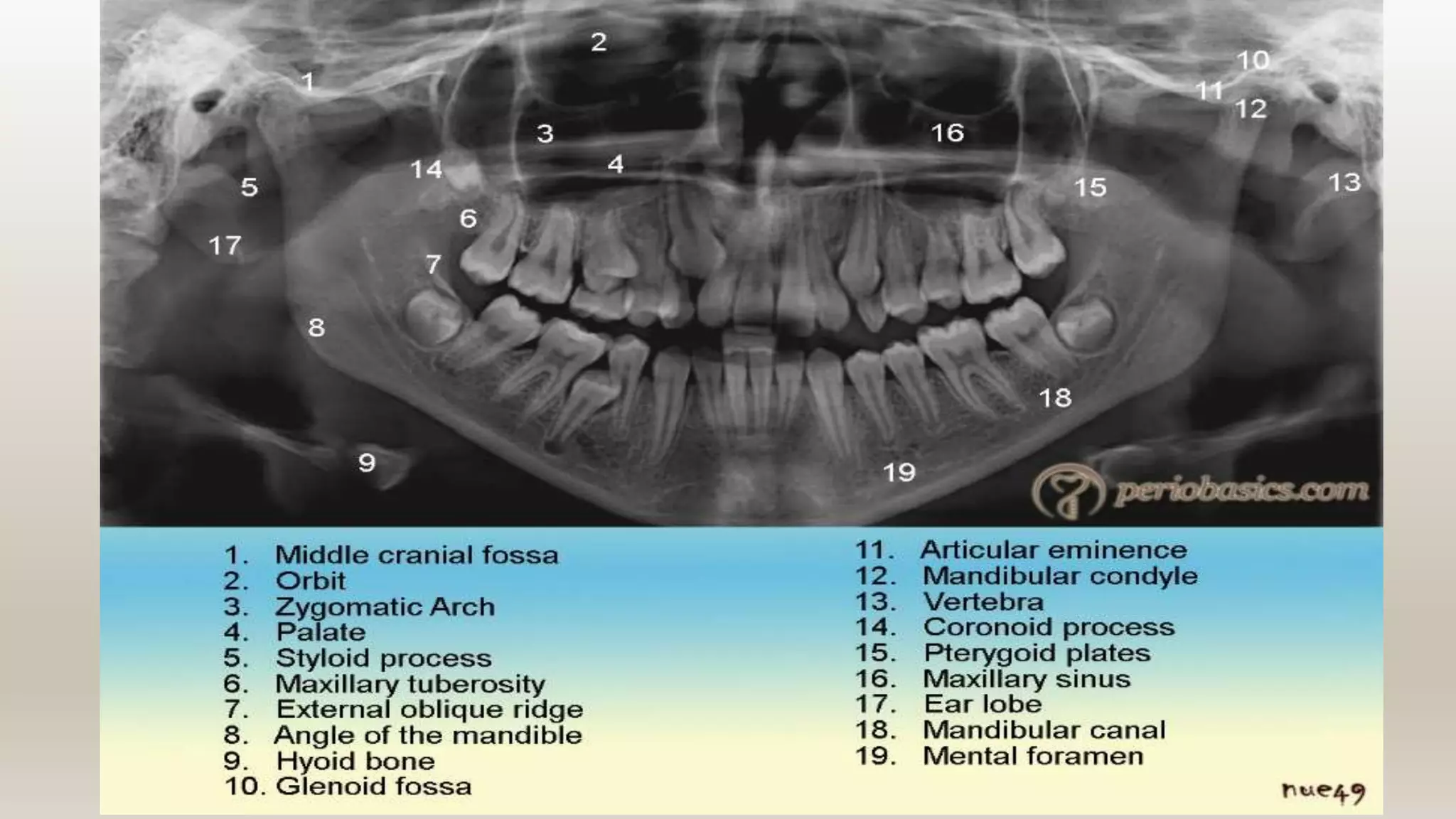 Radiographic Considerations in Implants | PPTX