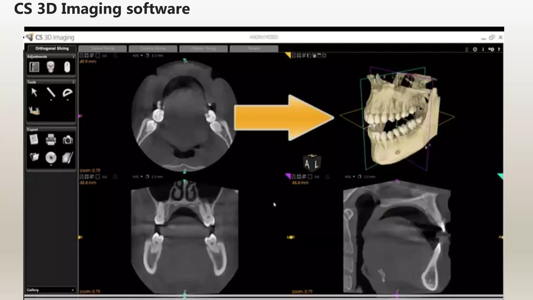 Radiographic Considerations in Implants | PPTX