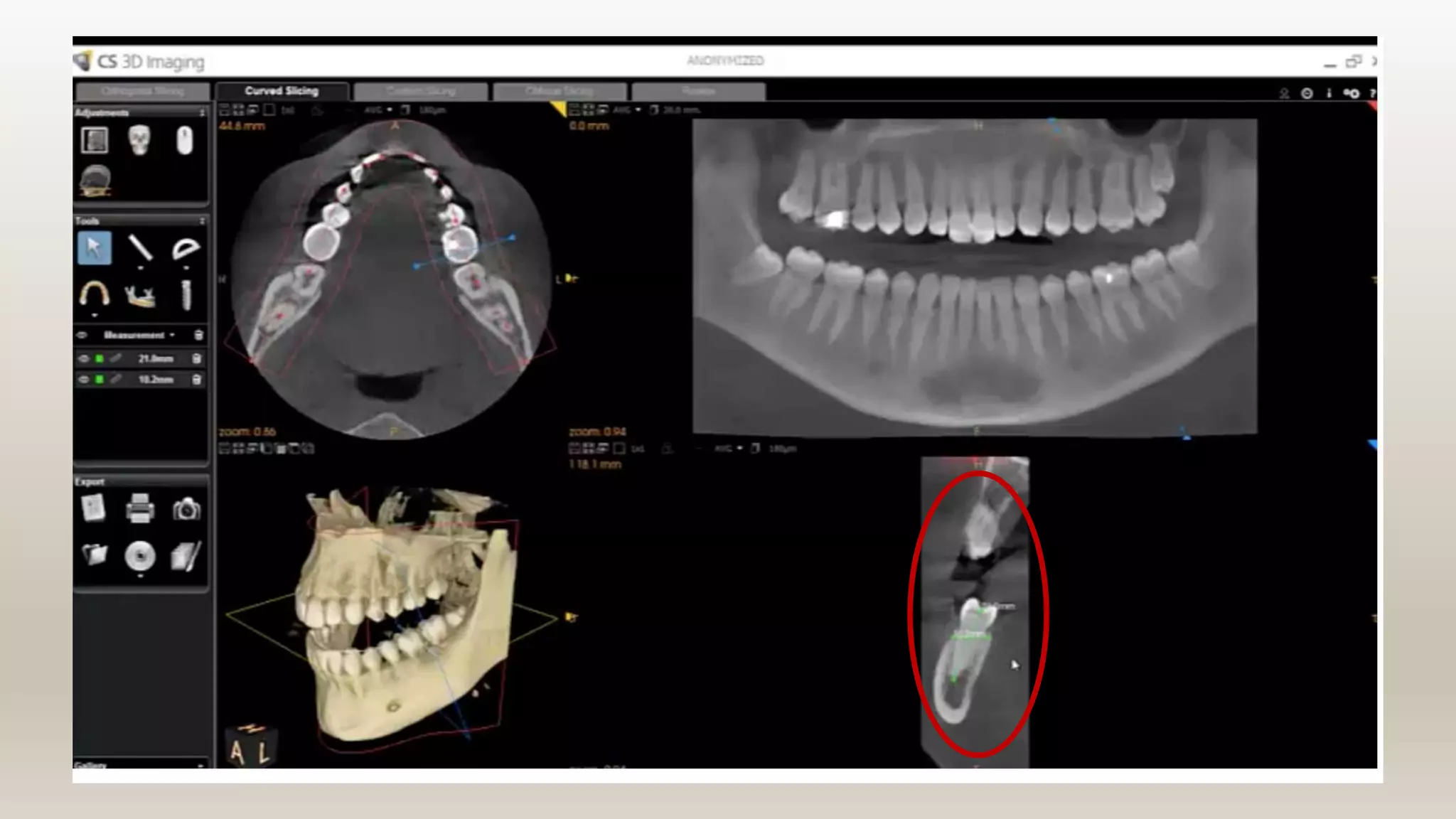 Radiographic Considerations in Implants | PPTX